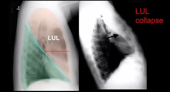 Lateral CXR- Pathology (Part 2) – EM in 5
