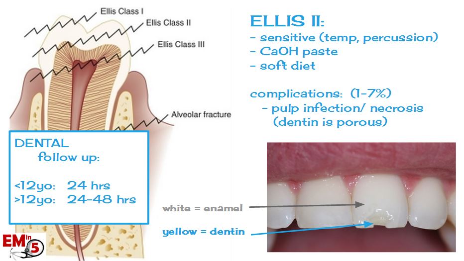 Dental Fractures – EM in 5