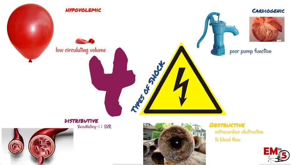 Shock! The 4 Types of Shock – EM in 5