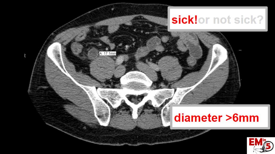 CT Imaging: Appendicitis – EM in 5