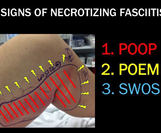 Necrotizing Fasciitis – EM in 5