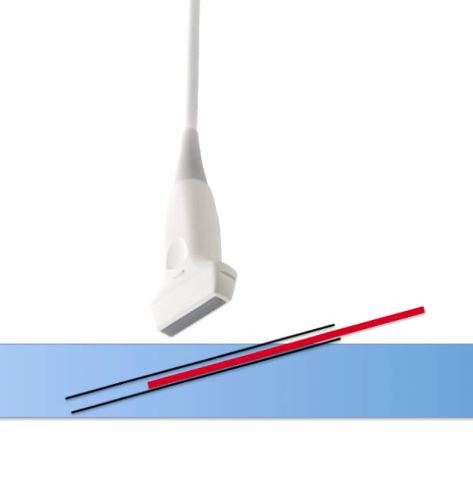 Ultrasound Guided IV Placement – EM in 5